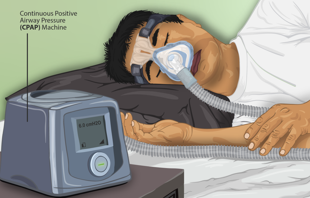 Mascarillas De CPAP Tama o Ideal Y Problmeas Dr Ferr M dico Del